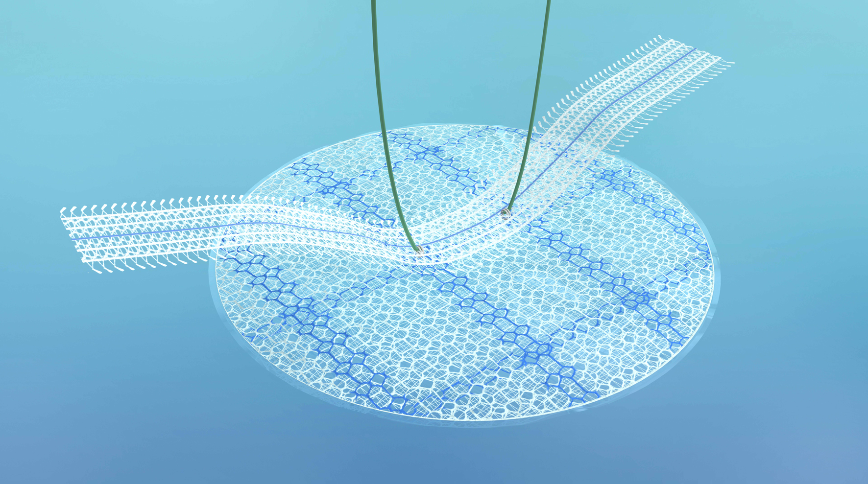 Umbilical and Epigastric Hernia Mesh - Mediway